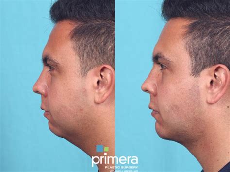 Cheek Fat Reduction