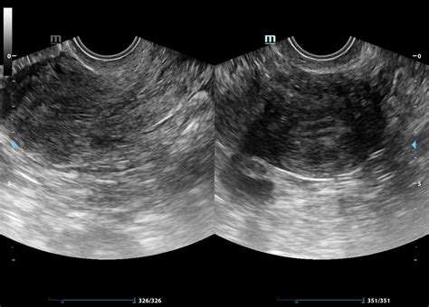 Ankle Msk Ultrasound Scan In Ballymena Private Scan