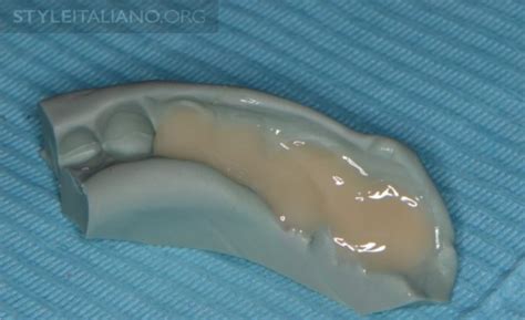 Opposing Occlusal Stamp Technique The Moos Technique