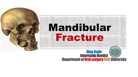 Mandibular Fractures Pptx