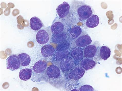 Metastatic Cells From Prostate Cancer In Bone Marrow Stock Image