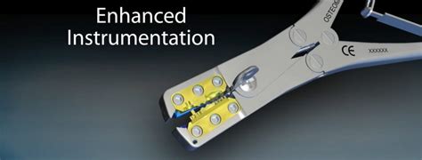 Osteomed Bone Plating