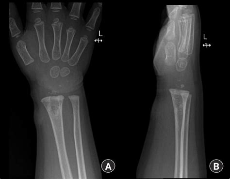 Four Month Follow Up Wrist X Ray With Disappearance Of The Lytic