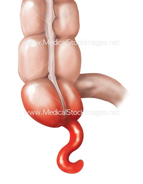 Inflamed Appendix Ultrasound A Safer Way To Diagnose Appendicitis In