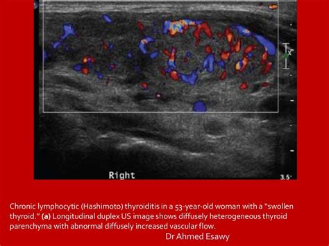 Tirads Thyroid Nodule Imaging Reporting And Data System Dr Ahmed E
