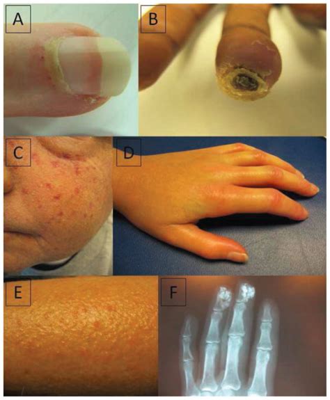 Telangiectasia Scleroderma