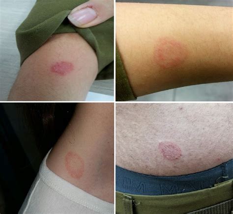 Microsporum Canis In Humans