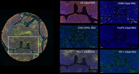 Spatial Phenotyping In Digital Pathology Defining A Multiplex If Image Analysis Workflow To