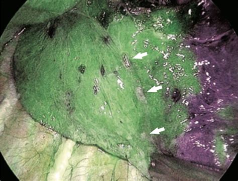 Thoracoscopic Lung Segmentectomy Under Indocyanine Green Icg Fluorescence Navigation Using