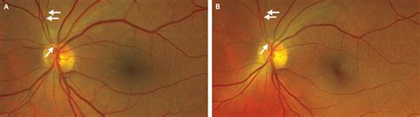 Branch Retinal Artery Occlusion