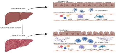 T Cells And Liver Fibrosis Portal Hypertension And Cirrhosis