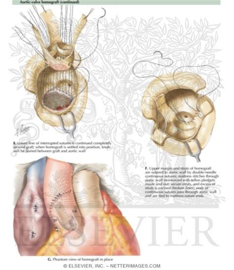 Aortic Valve Homograft