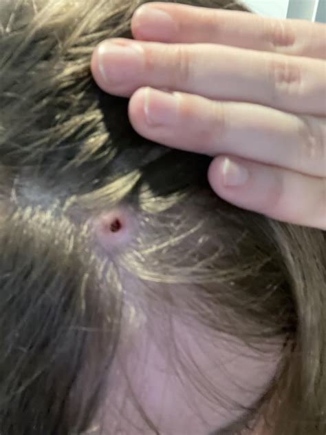 Just Took A Sebaceous Cyst Out Of My Scalp How Do I Prevent Infection R Dermatologyquestions