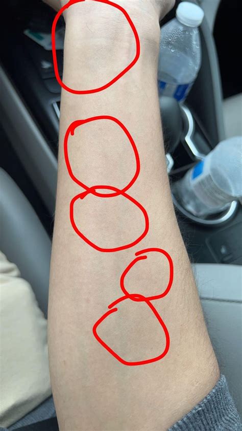 Noticed Random Spots On Forearm Rdermatologyquestions