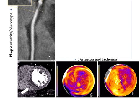 Ccta Biomarkers Useful For A Proper Definition Of Hf Patient Download Scientific Diagram