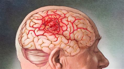 Cáncer De Cerebro Tipos Y Síntomas Gamma Knife