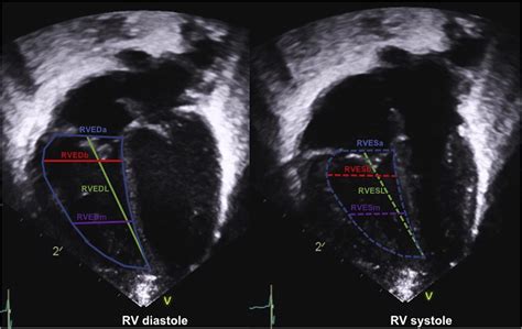 Echocardiographic Assessment Of Right Ventricular Function In Paediatric Heart Disease A