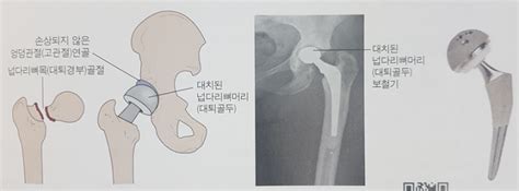 성인간호 근골격계인공관절 치환술고관절 치환total Hip Arthroplasty Tha슬관절 치환total