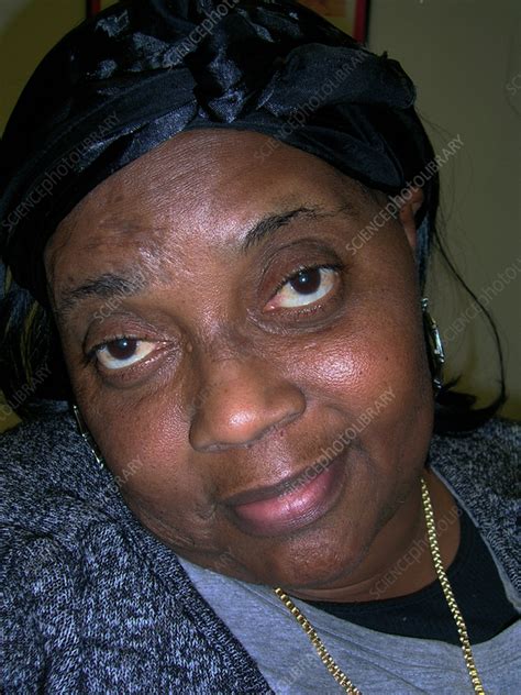 Sarcoidosis Treated With Infliximab Stock Image C056 2656 Science Photo Library