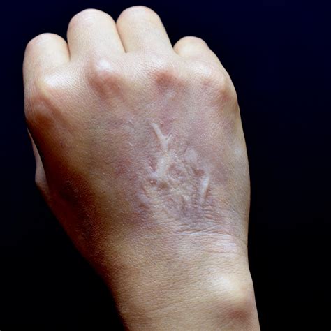 Skin Burn Scar