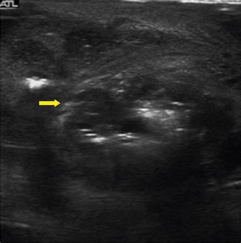 Emphysematous Epididymo Orchitis As A Camouflage Of Prostate Medicine