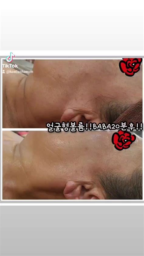 탄력 리프팅 얼굴형 주름 모공 피부톤 색소침착 한병에 동서융합화장품 케이셀채움baba 항상성 재현성 문제
