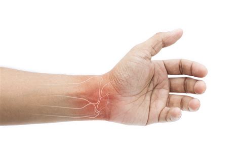 Tenosinovitis De Quervain Totalphysio