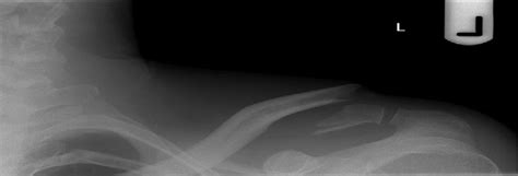 Radiograph Showing Lateral Third Displaced Fracture Of Clavicle Neer
