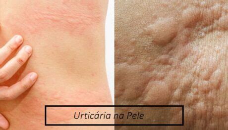 Remédio e Pomada para Urticaria no Corpo Irritação na Pele