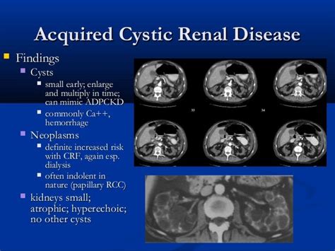 Cystic Renal Disease