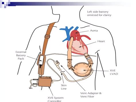 Advanced Ventricular Assist Device Ppt Pptx Heart And