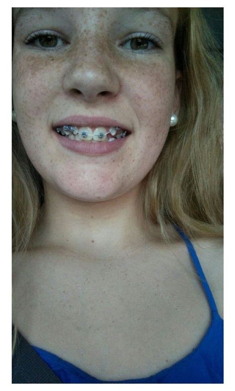 Braces Women Clothes Design Braces