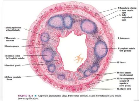 Pathology Of Acute Appendicitis Its Etiology Morphology Gross