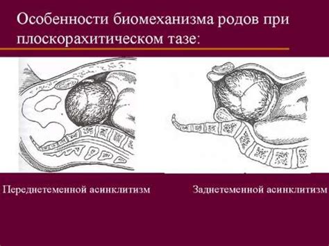 Узкий таз - презентация онлайн