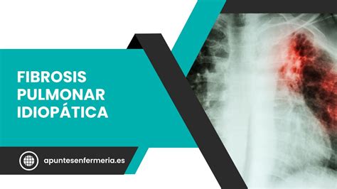 Fibrosis Pulmonar Idiopática Apuntes Enfermería