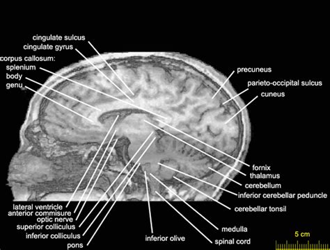 Sagittal Level 0302 As Mri