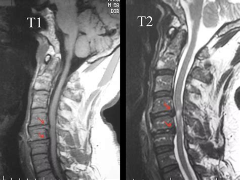 Cervical Spondylotic Myelopathy Ppt