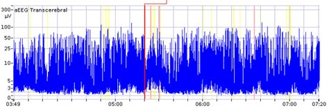 Application Of An Amplitude Integrated Eeg Monitor Cerebral Function