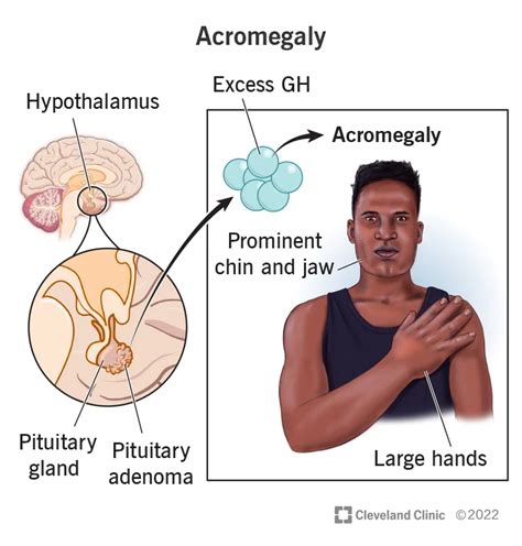 What Is Acromegaly And What Is The Cause Of This Disease
