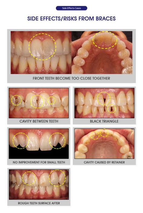 How Can I Get Perfect Teeth Alignment Dasha Taran