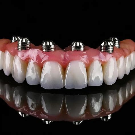 All On 6 Dental Implants Best Types And Materials Guide