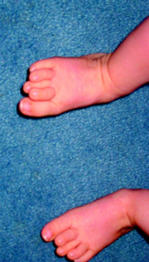 Toe Deformity From Prolonged Pulse Oximetry Archives Of Disease In