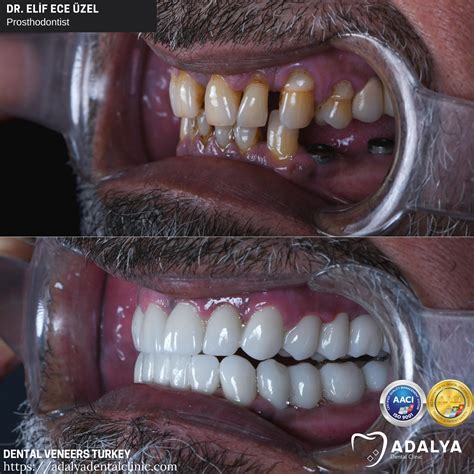 Dental Veneers Turkey Cost Porcelain Antalya Packages
