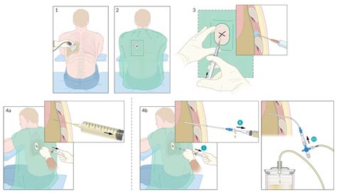 Toracocentesis Medicina Cardiometabólica