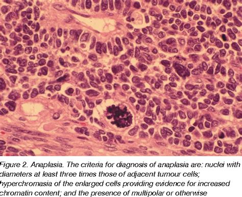Figure 3 From Management Of Wilms Tumour Current Practice And Future