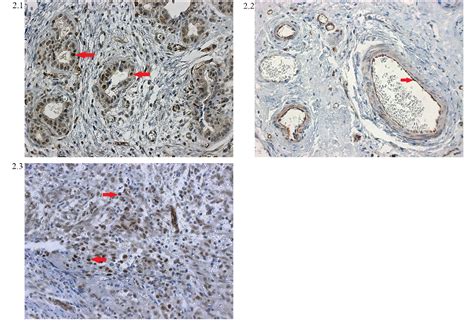 Figure 2 From Hif 1alpha Pathway Activation In Cholangiocytes Of Patients With Biliary Atresia