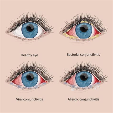 Demystifying Conjunctivitis Causes Symptoms Prevention And Treatment