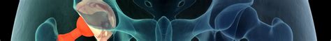Depuy Hip Replacements Pittsburgh Lawyers Free Consultation