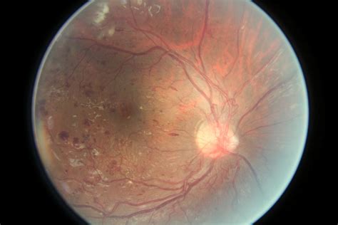 Feature Extraction From Retinal Fundus Image For Automated Grading Of Diabetic Retinopathy