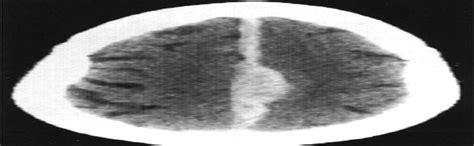 Interhemispheric Subdural Hematoma In Adults Case Reports A